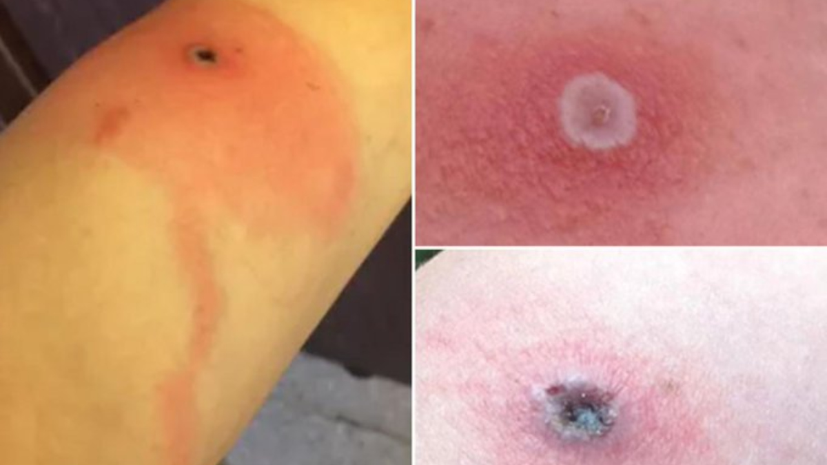 What Is Alaskapox, Alaska's First Fatal Case Of Viral Disease ...