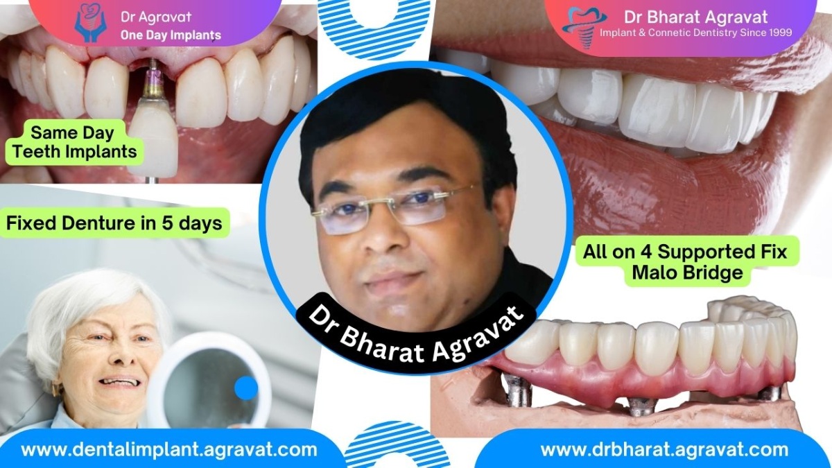 Best Dentist for Full Mouth Dental Implants Clinic in Ahmedabad: Dr. Bharat Agravat, the top ...