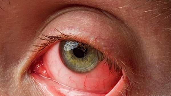 Pink Eye Infection Returns in Bengaluru, Raising Concerns Among Parents ...