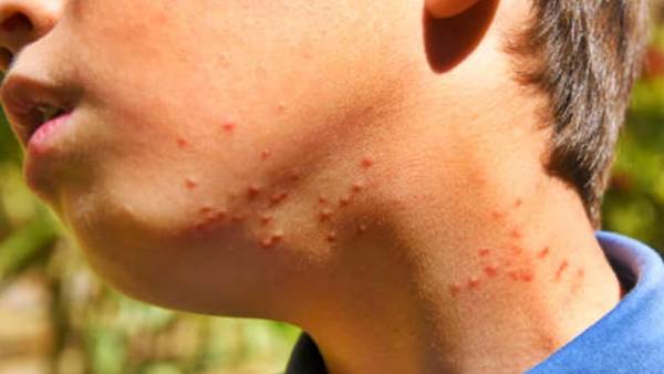 What is Scrub Typhus And It Symptoms; Everything You Need to Know In ...