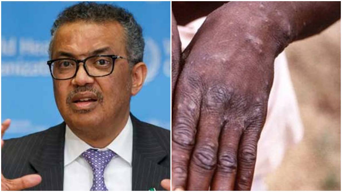 WHO Declared That monkeypox no more a Global health emergency ...