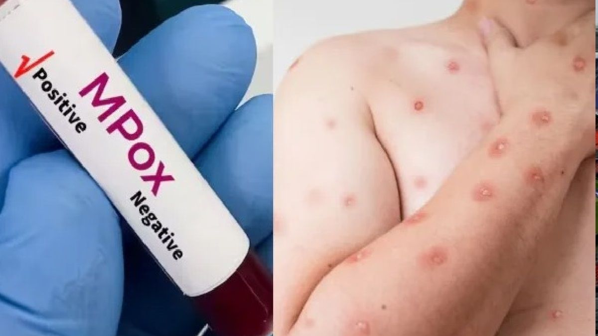 New strain of Mpox found in India, know how dangerous clade 1 strain ...