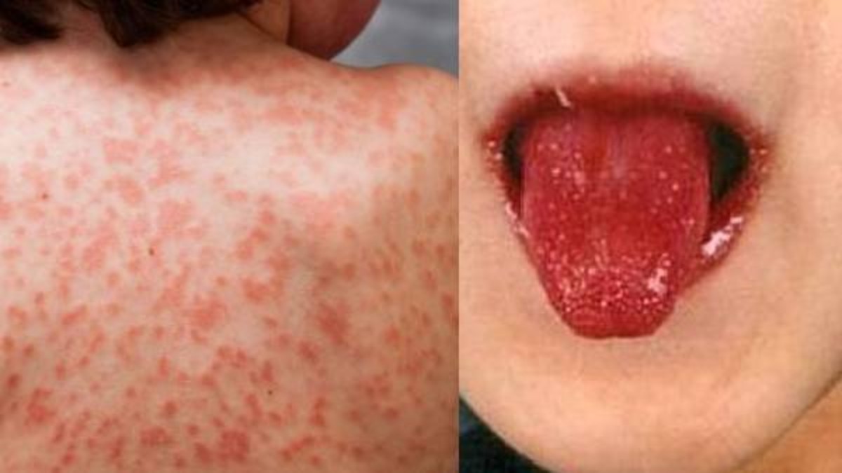 Munavar Farooqui's son had Kawasaki disease Know the symptoms in ...