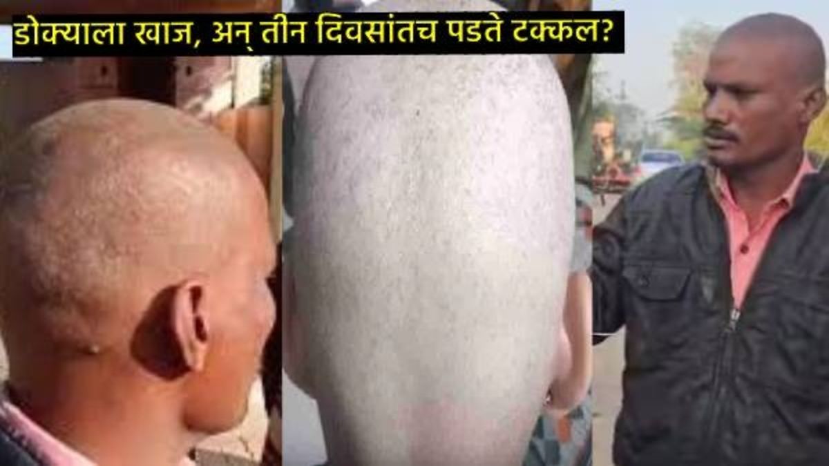 buldhana shegoan taluka many people hair loss baldness in 3 days ...