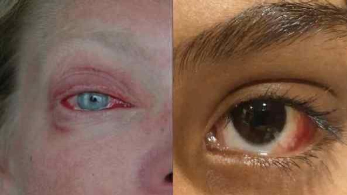 வேகமெடுக்கும் Madras Eye: பரவாமல் தடுப்பது எப்படி? நோய் அறிகுறிகள் யாவை ...