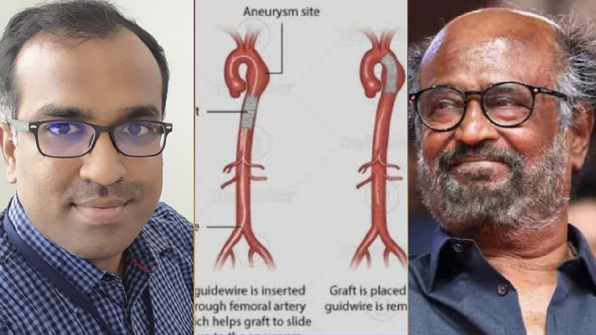 ரஜினிக்கு ஹை பிபியால் இதய ரத்த நாளங்களில் வீக்கம்! கேதிடரை செலுத்தும் ...