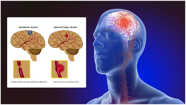 బ్రెయిన్ స్ట్రోక్ పిలుస్తోంది.. ఈ లక్షణాలుంటే తక్షణం డాక్టర్ ను ...